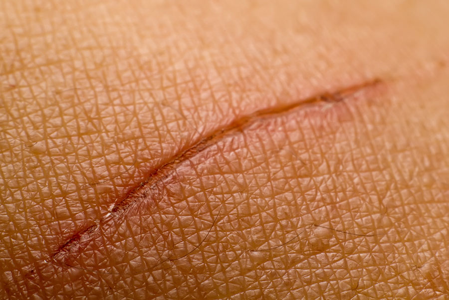 Cicatriz - Centro de Dermatología Avanzada
