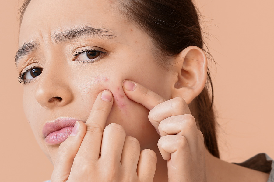 Acné en adolescentes y adultos. Opciones de tratamiento. - Centro de ...
